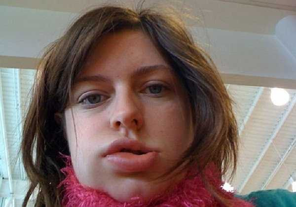 Cả người sưng phù vì bệnh quái ác