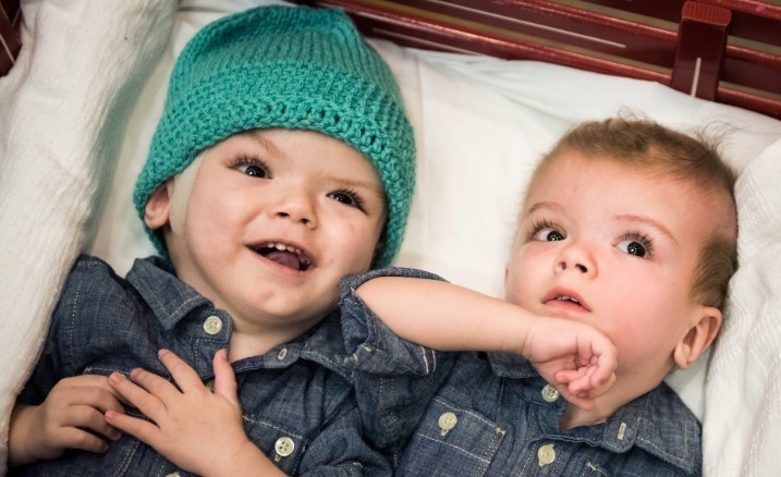 Sau phẫu thuật tách rời, cặp song sinh liền đầu ở Mỹ giờ ra sao?