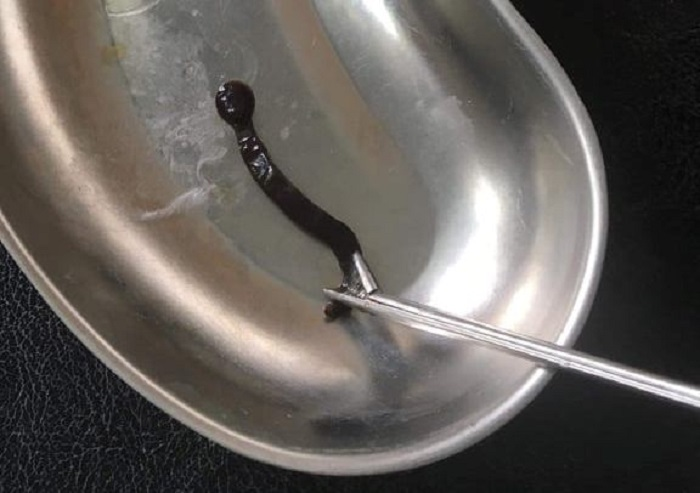 Con đỉa dài 4cm sống ký sinh cả tháng trời trong mũi bé gái 11 tuổi