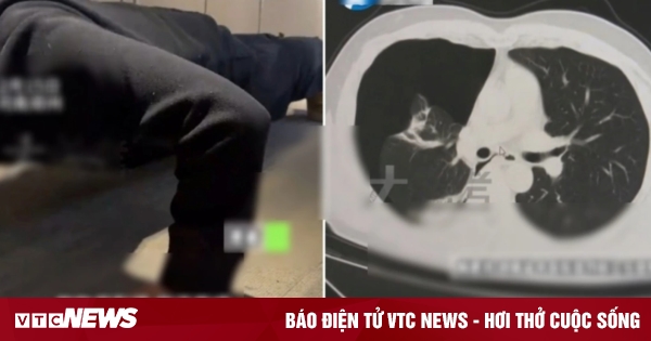 Xẹp phổi sau 20 lần chống đẩy và nhảy dây